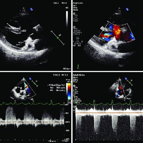 Echocardiography Showing Dorv Large Subaortic Ventricular Septal