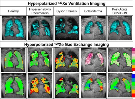 Xenon Mri Research Program