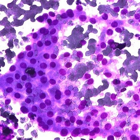 Focal Chronic Thyroiditis Patchy Lymphocytic Inflammation With Small Download Scientific