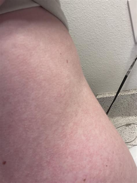 Flat Rash Hot To Touch No Itching Please Help Rdermatologyquestions