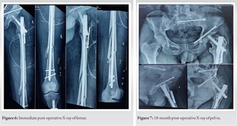 Ipsilateral Floating Hip And Floating Knee With Multiple Fractures A Case Report Journal Of