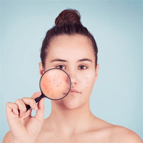 Acne And Dark Spots Soulboundindia