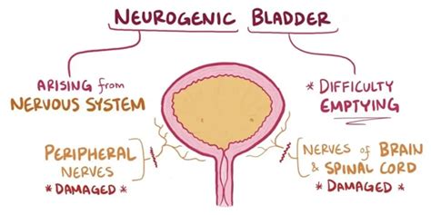 Neurogenic Bladder Dubai Drhc Dubai Urology Clinic