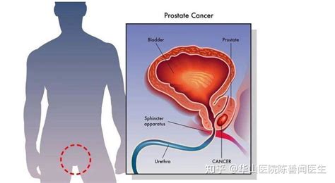 前列腺癌发生骨转移怎么办？ 知乎