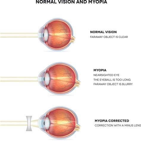 4 Types Of Refractive Errors Plus Treatment Options