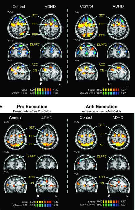 Saccade Preparation A And Saccade Execution B Contrast Maps A