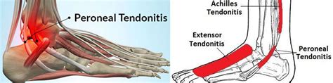 Peroneal Tendonitis