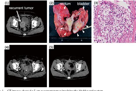 Figure 1 From Successful Management Of Pelvic Recurrence Of Msi High Endometrial Cancer By Total