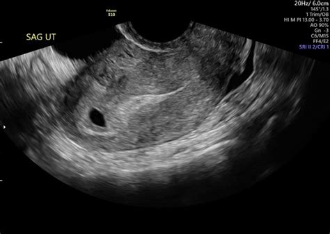 5 Weeks Gestation What Should I See Sonosession