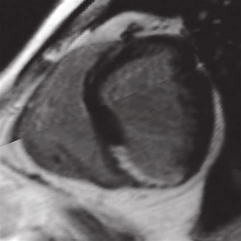 Misalignment Correction Results Illustrated With Intersections Between Download Scientific