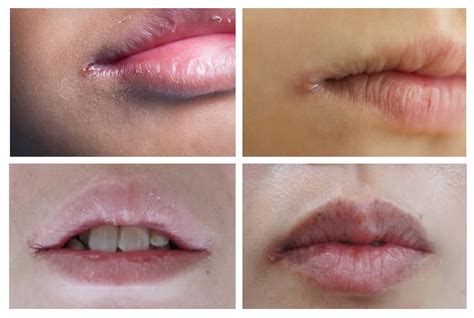 Infectious Cheilitis