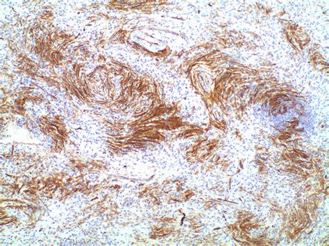 Pathology Outlines Inflammatory Fibroid Polyp