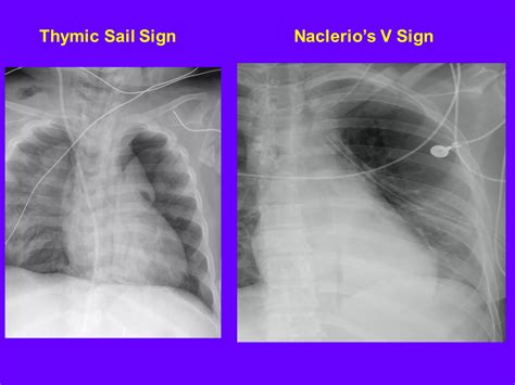 Radiological Signs In Chest Medicine Part 2 Pdf Lung And Respiratory Health Diseases And