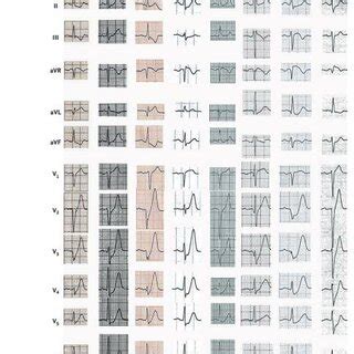 Unique Precordial ST Segment And T Wave Morphology These Lead ECG Download Scientific