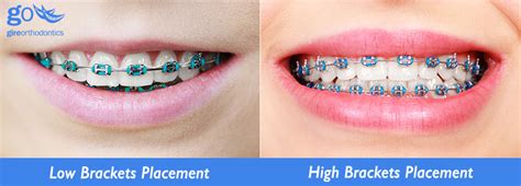 Very Back Bracket For Braces