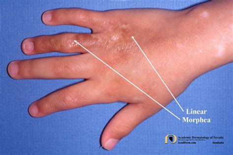 Atrophy Skin Atrophy Skin