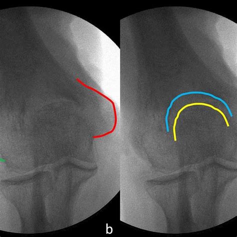 A Anteroposterior Ap View Of The Proximal Part Of The Forearm B The Download Scientific