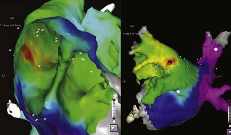 Electrophysiological Evaluation Of Atrial Tachycardia And Atrial Flutter Thoracic Key
