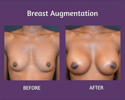 Choosing The Right Natural Looking Breast Implants Del Mar Plastic
