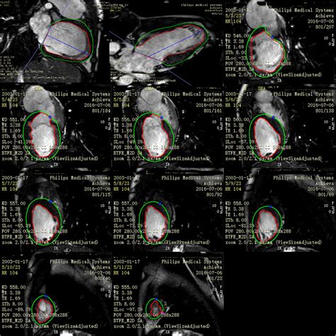 2d Global Longitudinal Strain And Global Circumferential Strain And