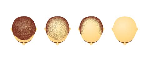 Male Pattern Baldness Treatment In London Scalp Provoco
