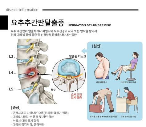 허리 통증 허리가 아파요 다리가 저려요 요추 추간판탈출증 허리 디스크 제천 한의원 네이버 블로그