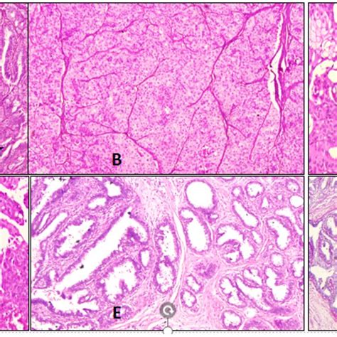 solid papillary carcinoma with the predominant solid areas with focal