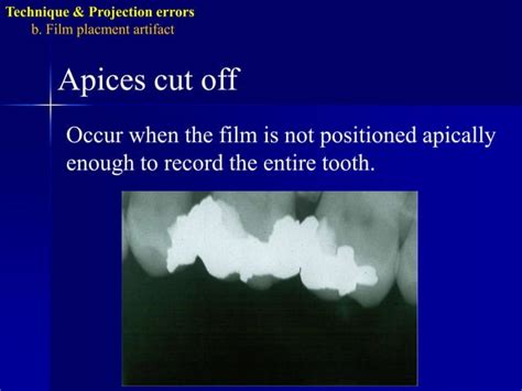 Radiographic Errors And Artifacts Pptx Photo Editing Software