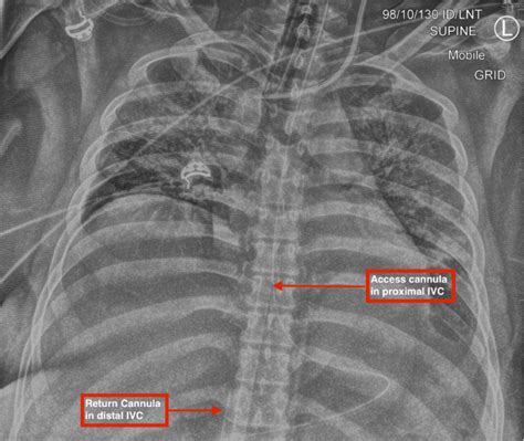 What To Do When The Spo2 Still Stays Low On Vv Ecmo Intensive
