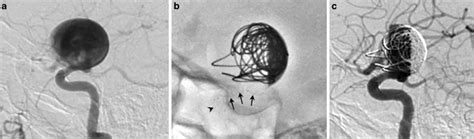 A Large Aneurysm A Arising From The Ophthalmic Segment Of The Right Download Scientific