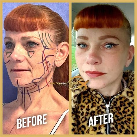 Wat Is Een Deep Plane Face Lift Operatie Health And Beauty Travel