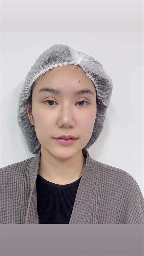 เคสเดิม เอียง ปลายบาง ระยะสุดท้าย เสี่ยงทะลุ เเก้ ด้วยโปรแกรม รอง กระดูกอ่อนหลังหู และเนื้อเยื่อ