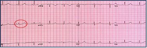 The Qt Interval Represents The Time Between The Beginning Of The Q Wave