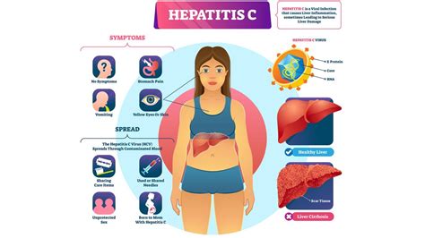 Hepatitis C Basics Liver Infection Symptoms And Prevention Los