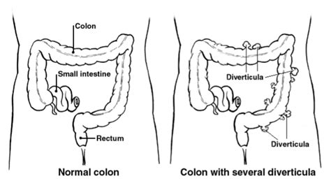 Diverticular Disease East Lancashire Hospitals Nhs Trust