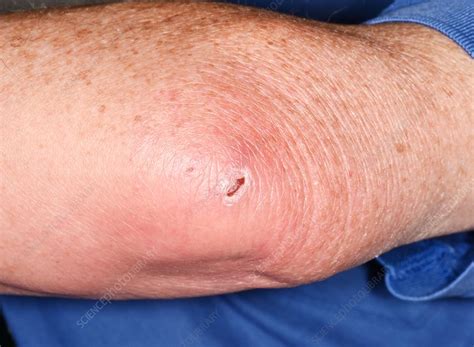Infected Olecranon Bursitis Stock Image C037 0839 Science Photo Library