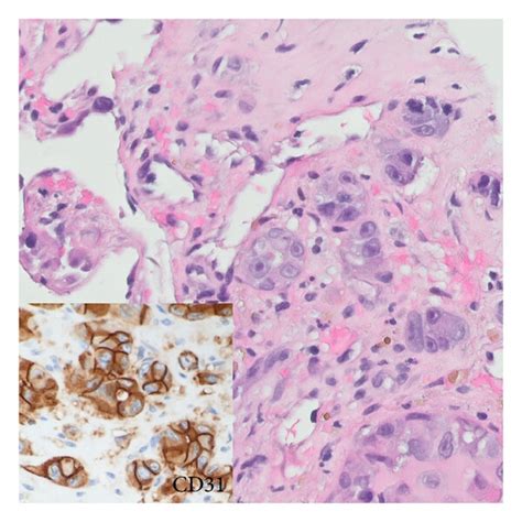 Myc Amplification In Angiosarcoma Arising From An Arteriovenous Graft