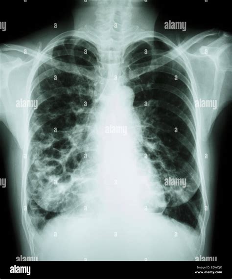 Chest X Ray Pneumonia