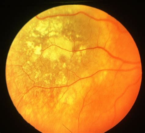 Choroidal Melanoma Retina Image Bank