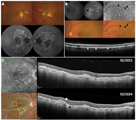 Pseudoxanthoma Elasticum Genetics Pathophysiology And Clinical Presentation Pmc