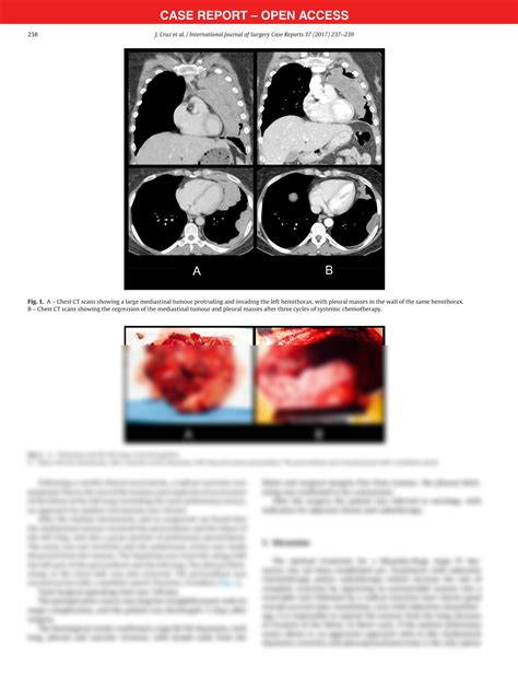Solution Extended Thymectomy Left Pneumonectomy Pericardiectomy And Partial Pleurectomy For A