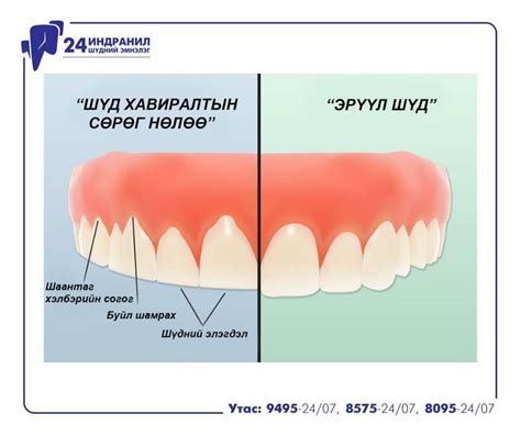 ШҮД ХАВИРАХ ЭМГЭГ Шүдээ хавирах эмгэг буюу бруксизм гэдэг нь өдрийн