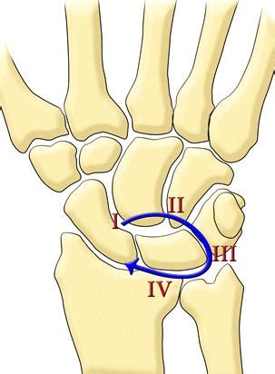 Lunate Dislocation Perilunate Dissociation Hand Orthobullets