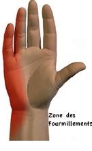 Compression Du Nerf Ulnaire Docteur Faivre Chirurgie De La Main