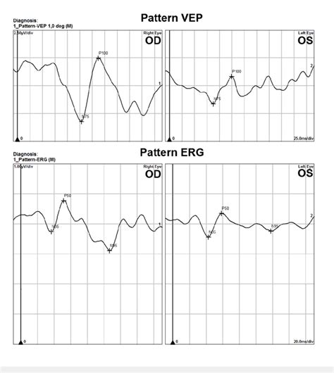 Pattern Visual Evoked Potential Vep And Pattern Electroretinography Download Scientific