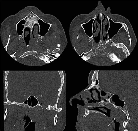 Multiplanar Ct Reconstructions Demonstrate A Left Sided Soft Tissue Download Scientific Diagram