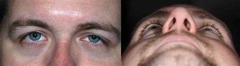 Enophthalmos Definition Causes Symptoms Diagnosis And Treatment