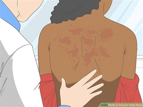 How To Prevent Heat Rash 14 Steps With Pictures WikiHow