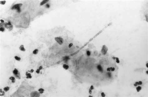 Candida Sp In Sputum The Pseudohyphae Of Candida Often Pierce Download Scientific Diagram