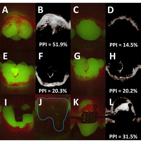 Semi Automated Planimetric Quantification Of Dental Plaque Using An